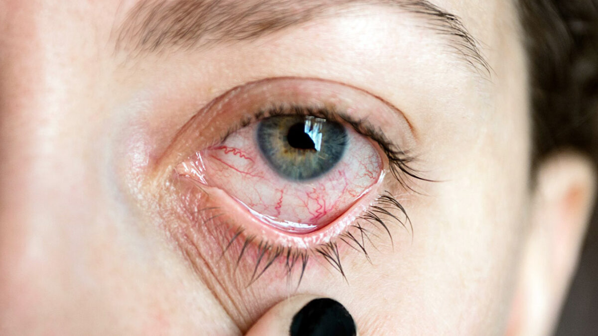 Uveitis | Symptoms, Causes & Treatment