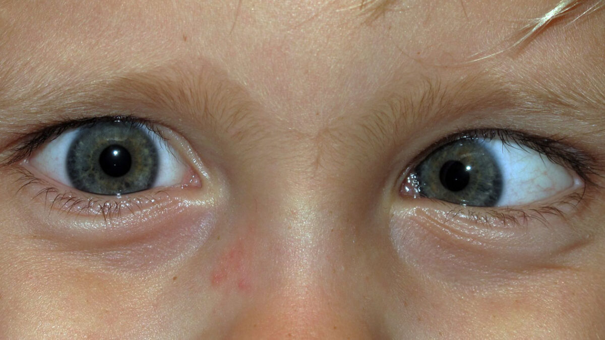 Strabismus | Symptoms, Causes & Treatment